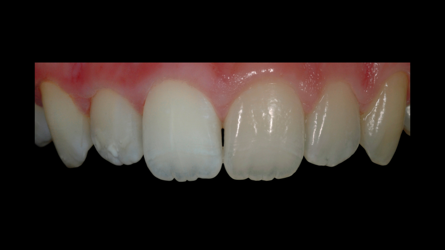 Shade Matching Made Easy | Digital Dental Photography